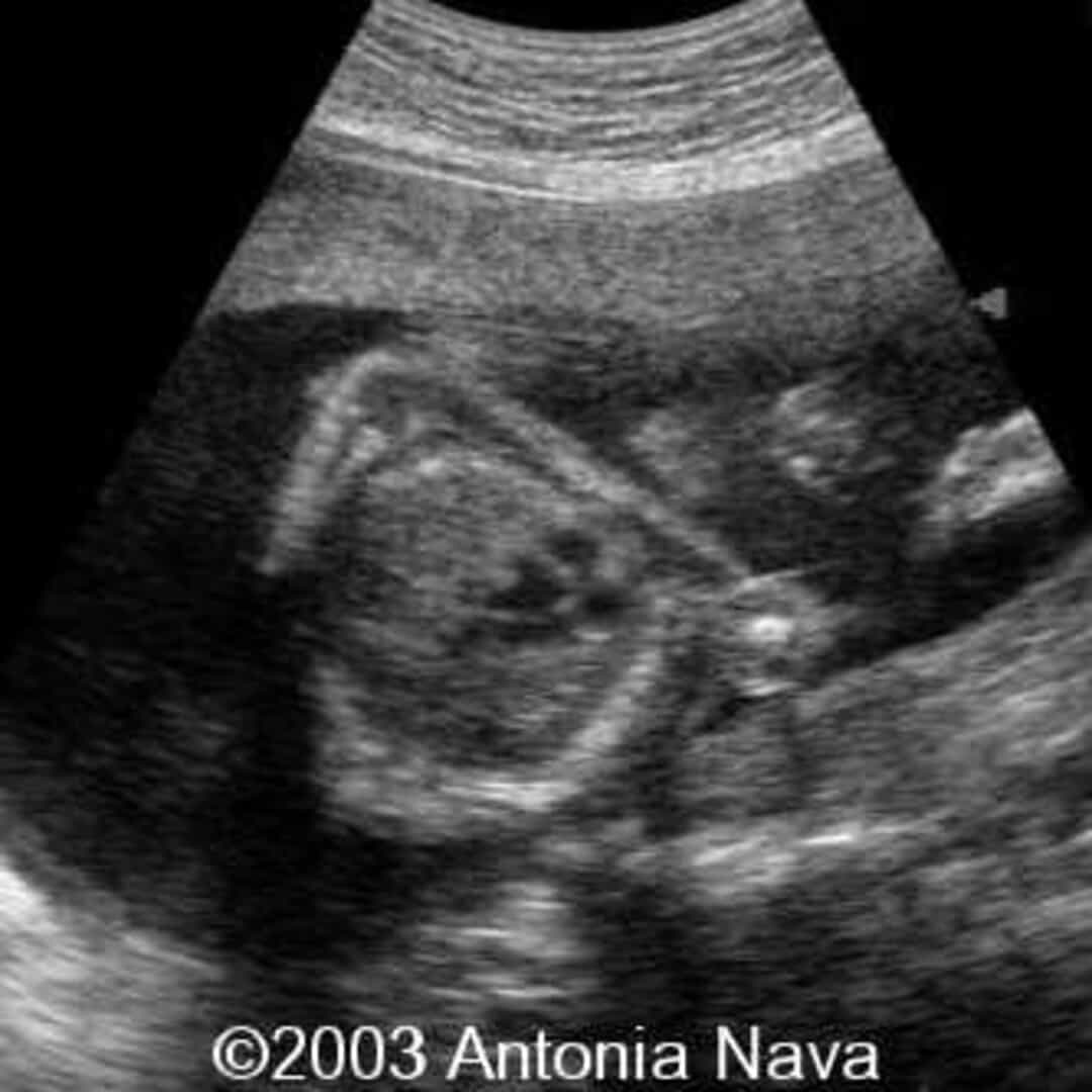 📃 Twins, conjoined, duplicata incompleta dicephalus