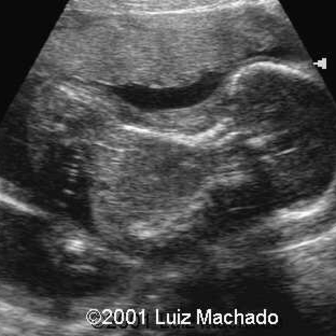 📃 Twins, conjoined, duplicata incompleta dipygus