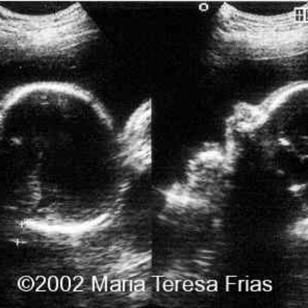 📃 Trisomy 21, 29 weeks