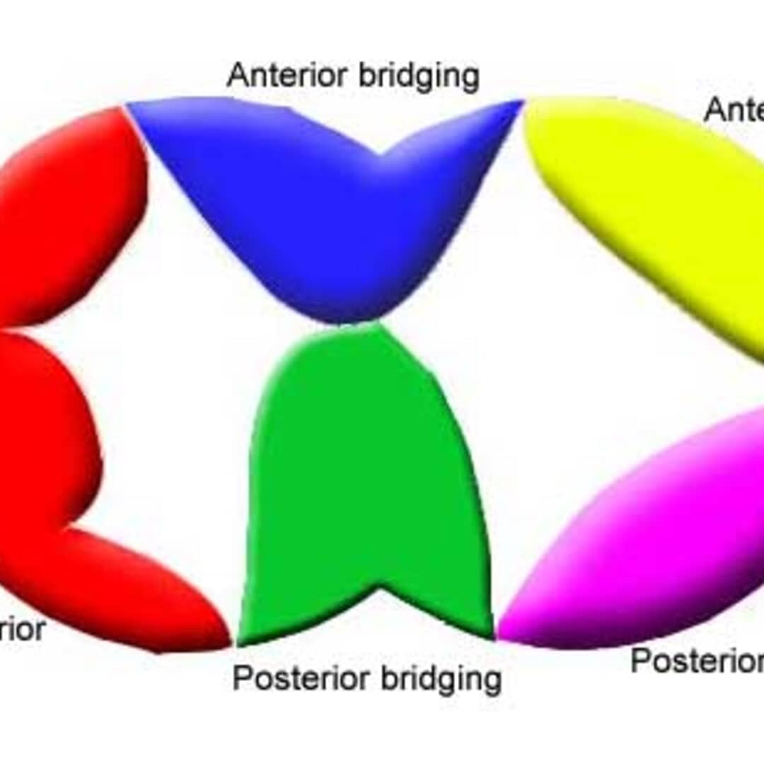 📃 Intermediate atrioventricular septal defect