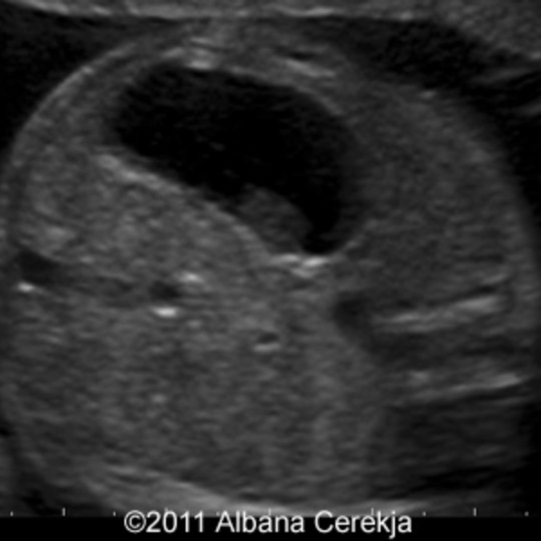 📃 Duodenal stenosis