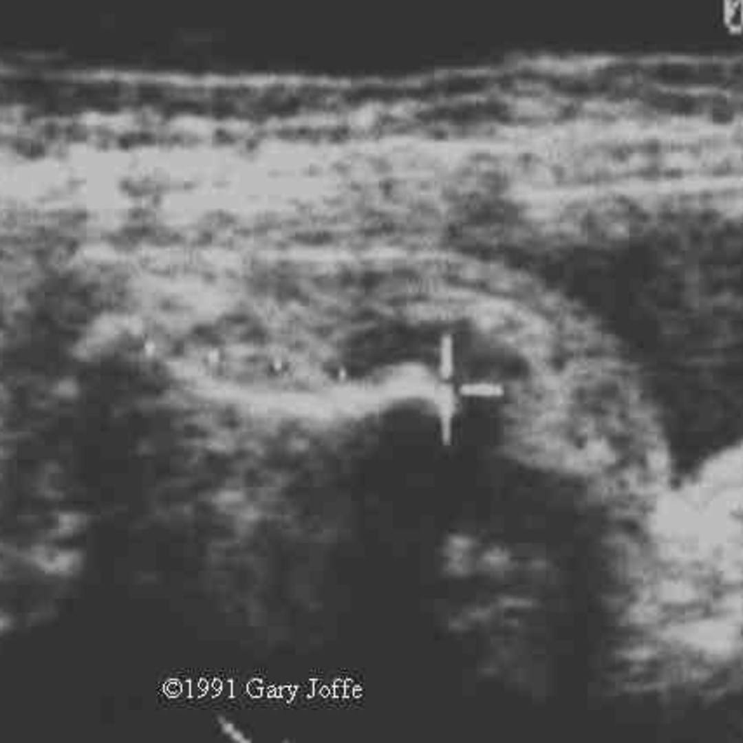 📃 Dyssegmental dysplasia of the Silverman-Handmaker type