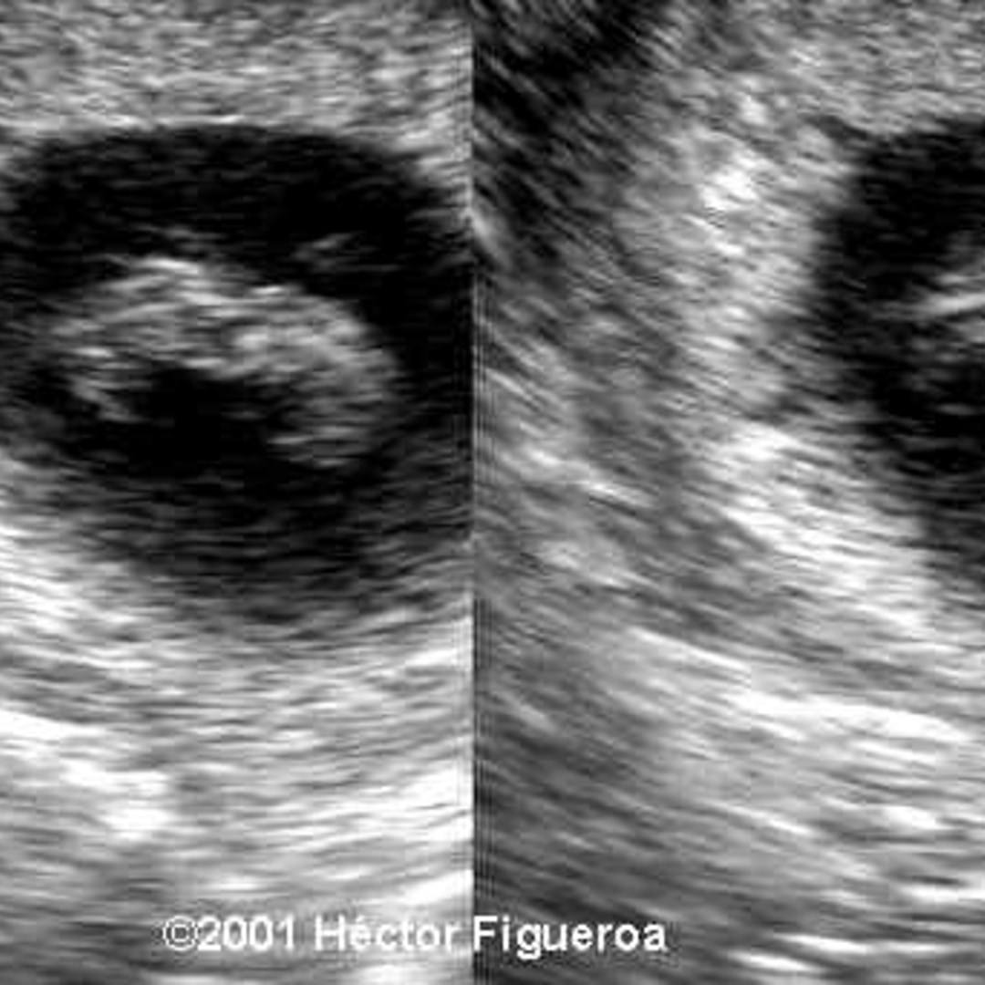 twins sonogram 8 weeks