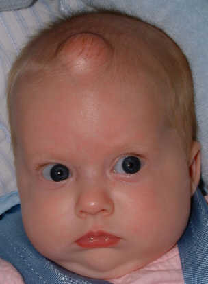 Dermoid Cyst Forehead