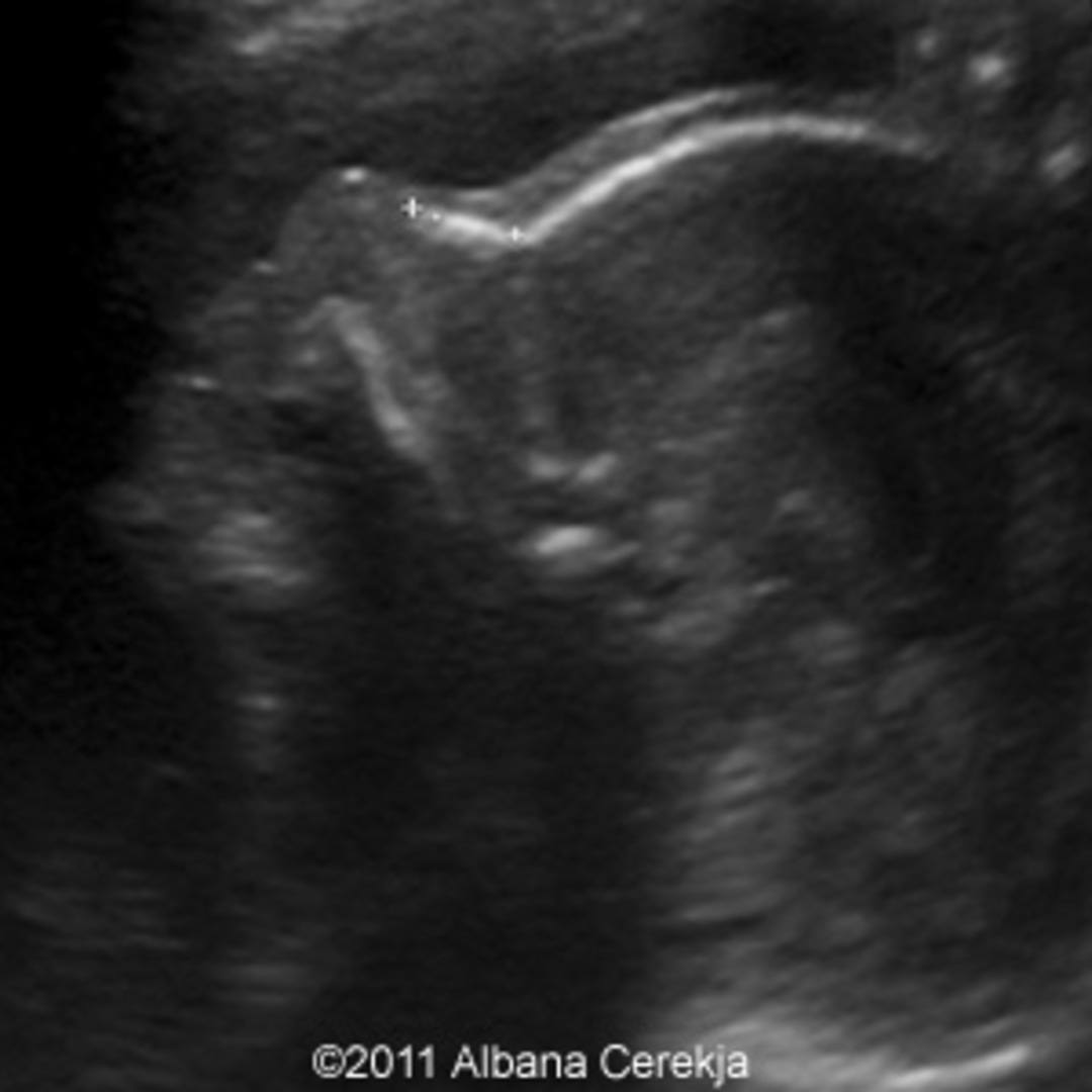 📃 Tetralogy of Fallot