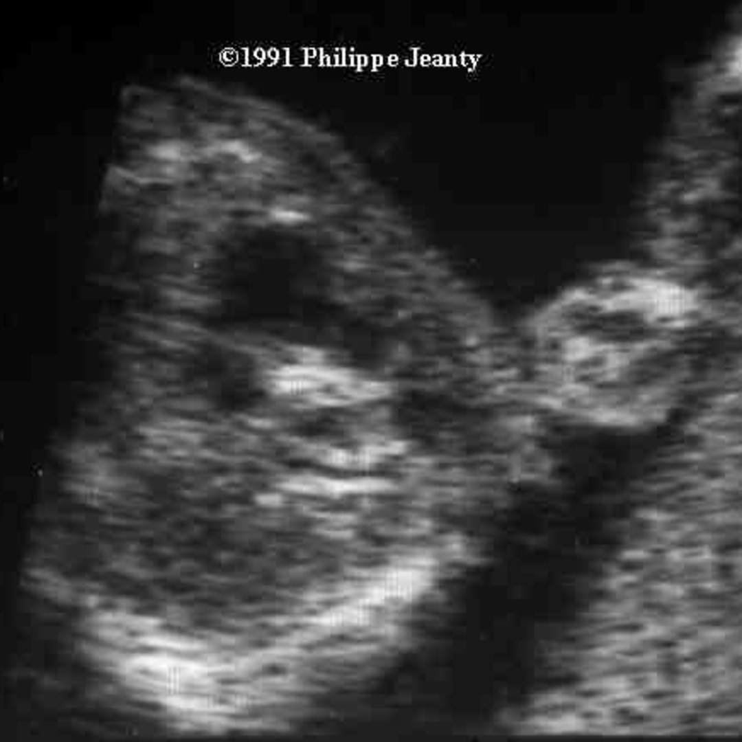 📃 Cardiac Fibroma