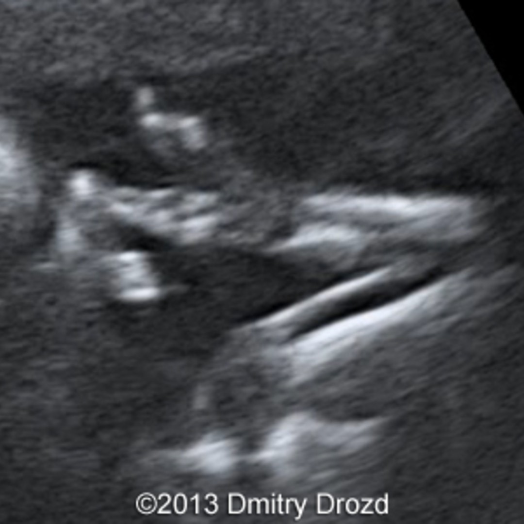 📃 Split-hand split-foot syndrome