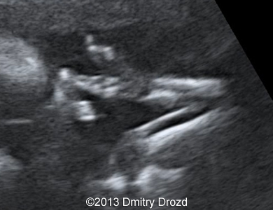 📃 Split-hand split-foot syndrome