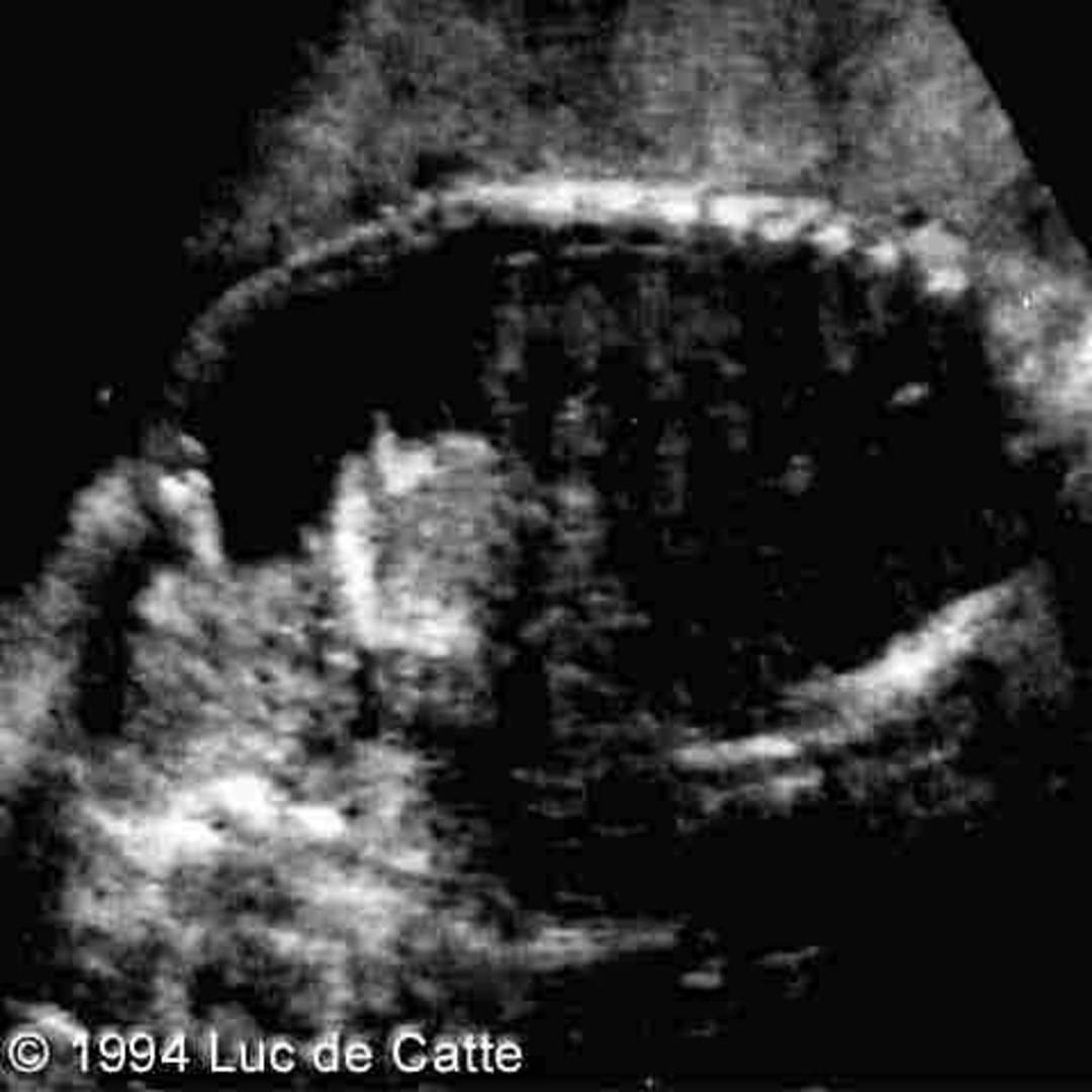 📃 Meconium Peritonitis Spontaneous Resolution