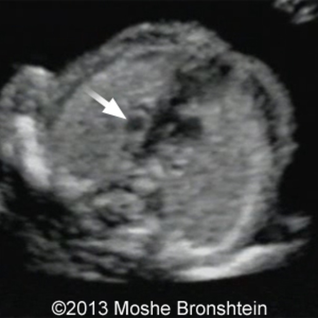 📃 DiGeorge syndrome - new sonographic markers: pedal edema and ...