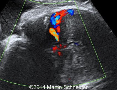 📃 Arteriovenous malformation of the right middle cerebral artery