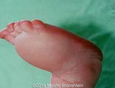 📃 Milroy's disease