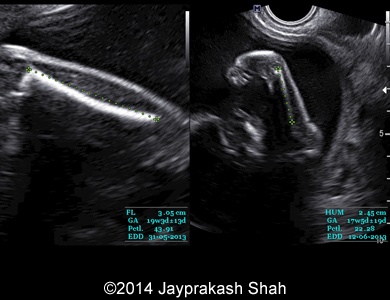 📃 Radial ray aplasia, unilateral
