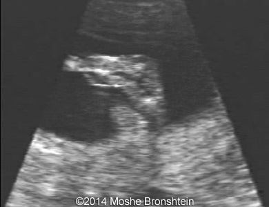 📃 Milroy's disease