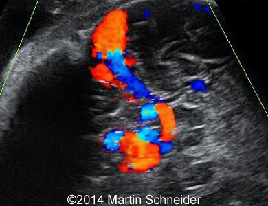 📃 Arteriovenous malformation of the right middle cerebral artery
