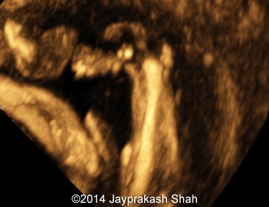 📃 Radial ray aplasia, unilateral