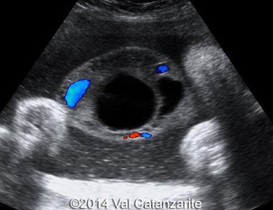 📃 Umbilical cord cyst, allantoic