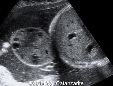 📃 Umbilical cord cyst, allantoic