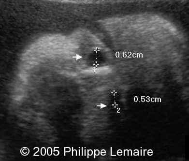 📃 Dacryocystocele, 3D rendering