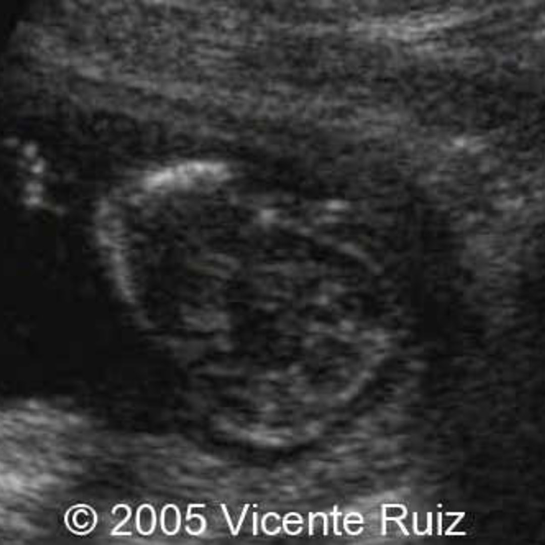 📃 Acrania due to amniotic band