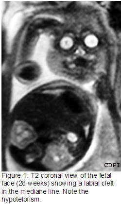 📃 MRI, Cleft lip/palate