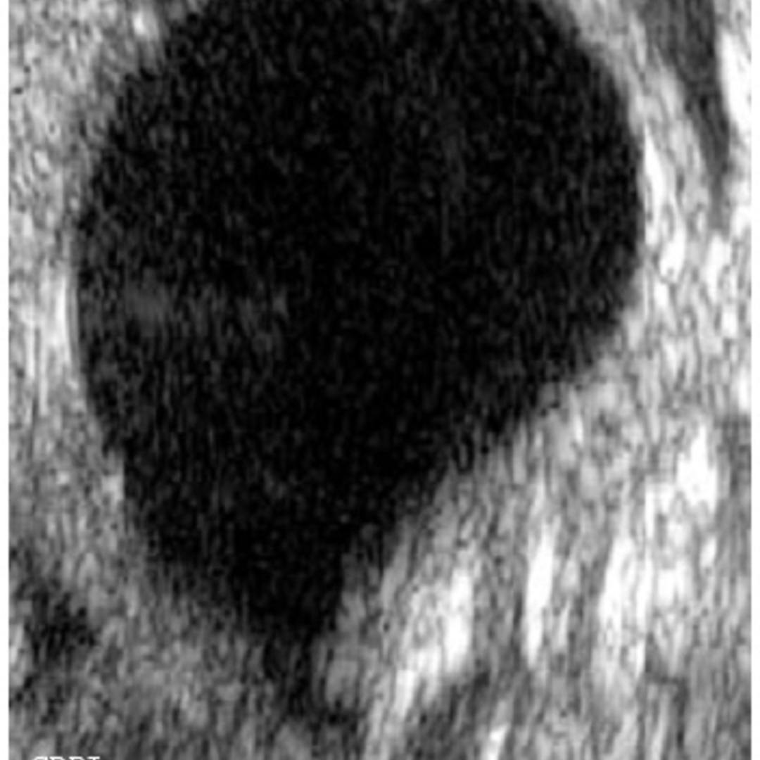Posterior Urethral Valves posterior-urethral-valves
