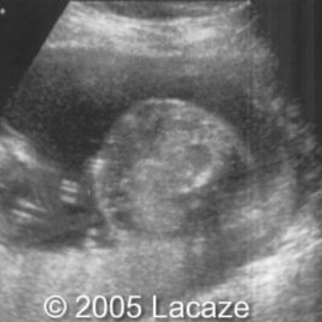 📃 TRAP, acardiac, acephalus