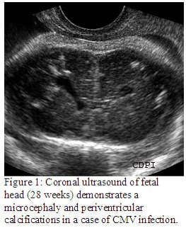 📃 Microcephaly
