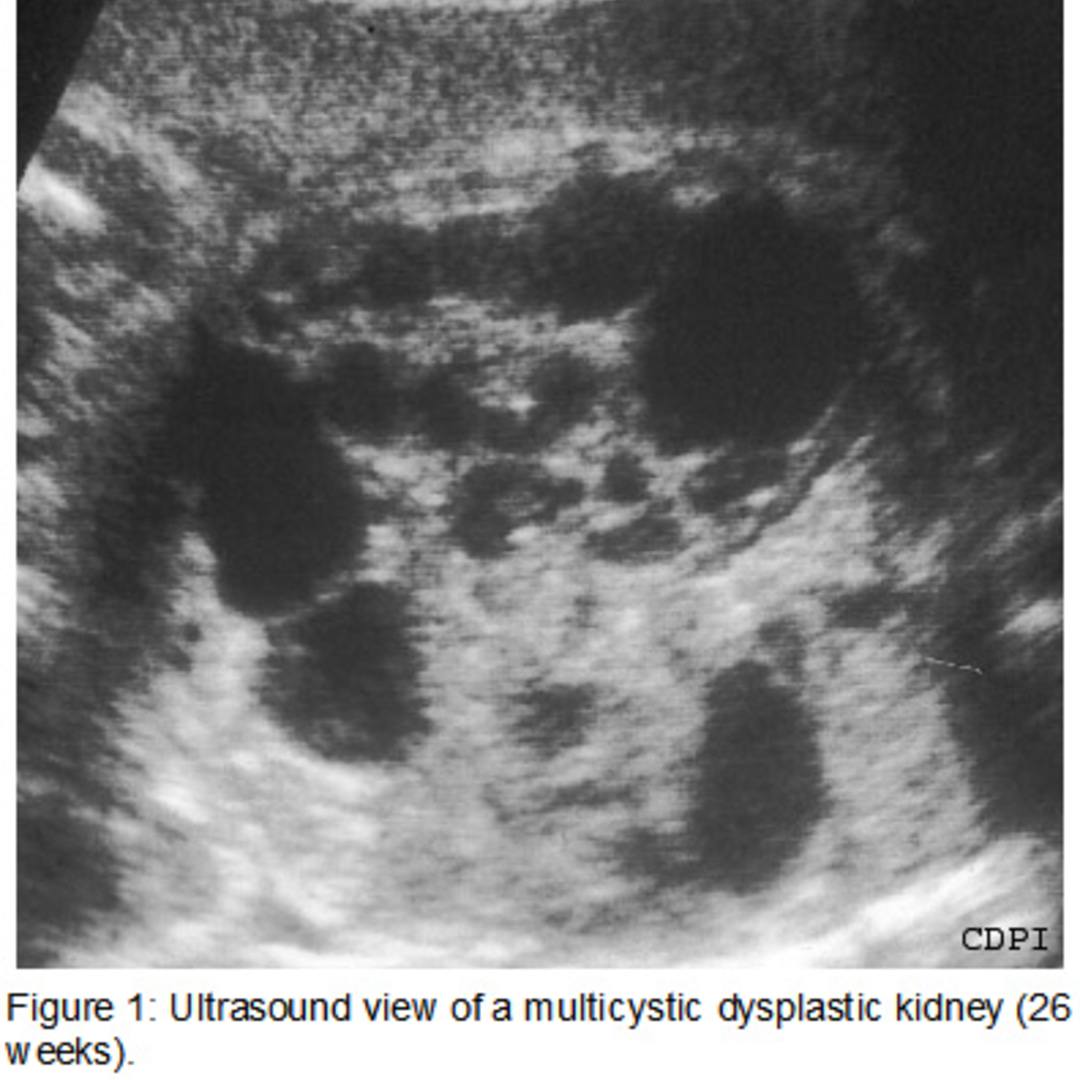 📃 Multicystic dysplastic kidney