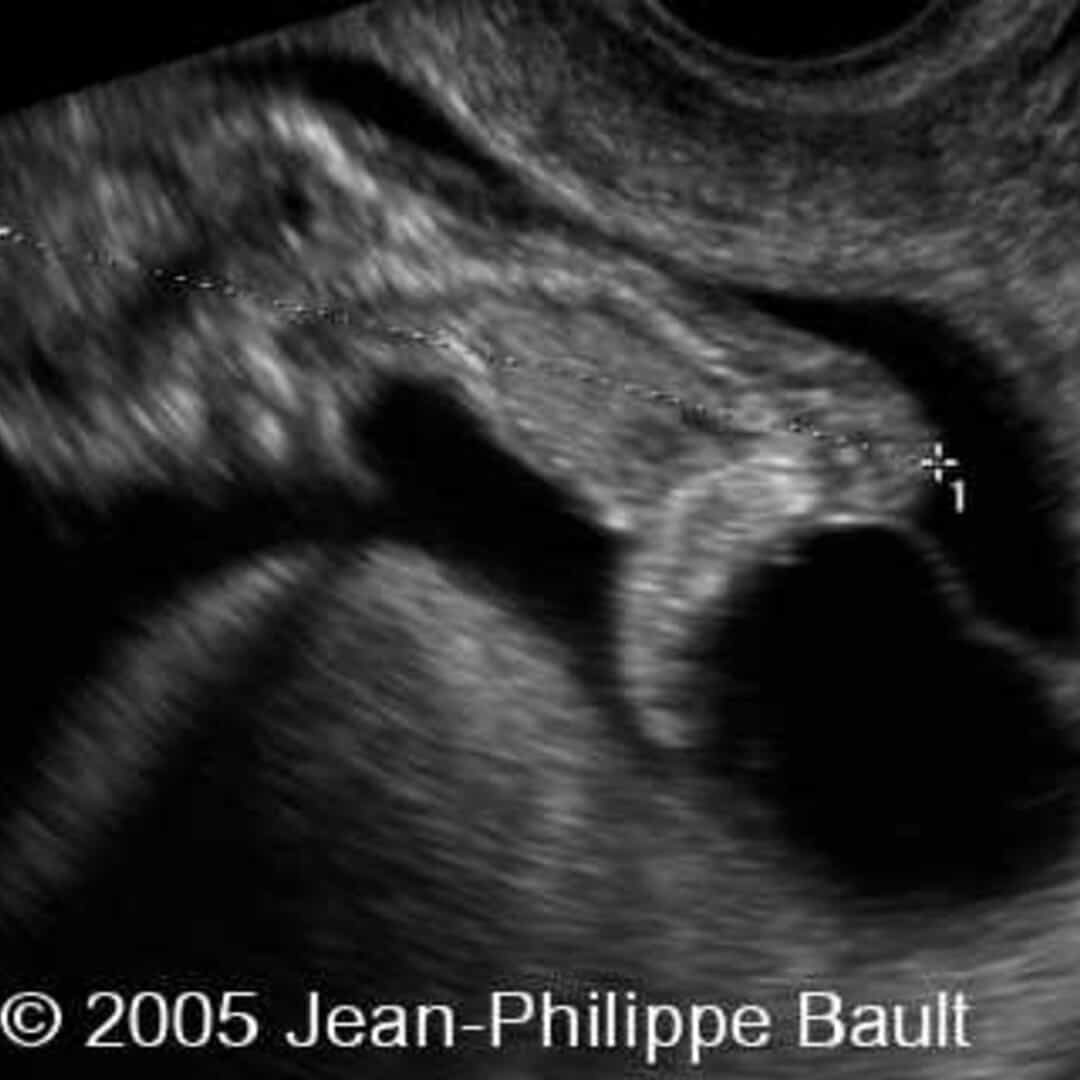 📃 Exstrophy of the cloaca