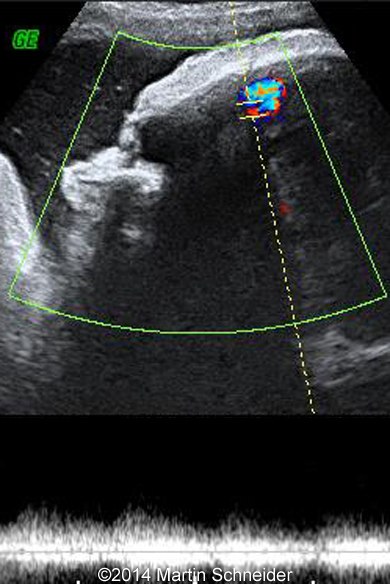 📃 Arteriovenous malformation of the right middle cerebral artery