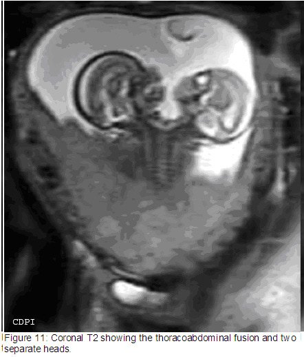 📃 MRI, Conjoined twins