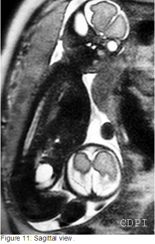 📃 MRI, Sacral agenesis