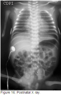 Sacral Agenesis X Ray