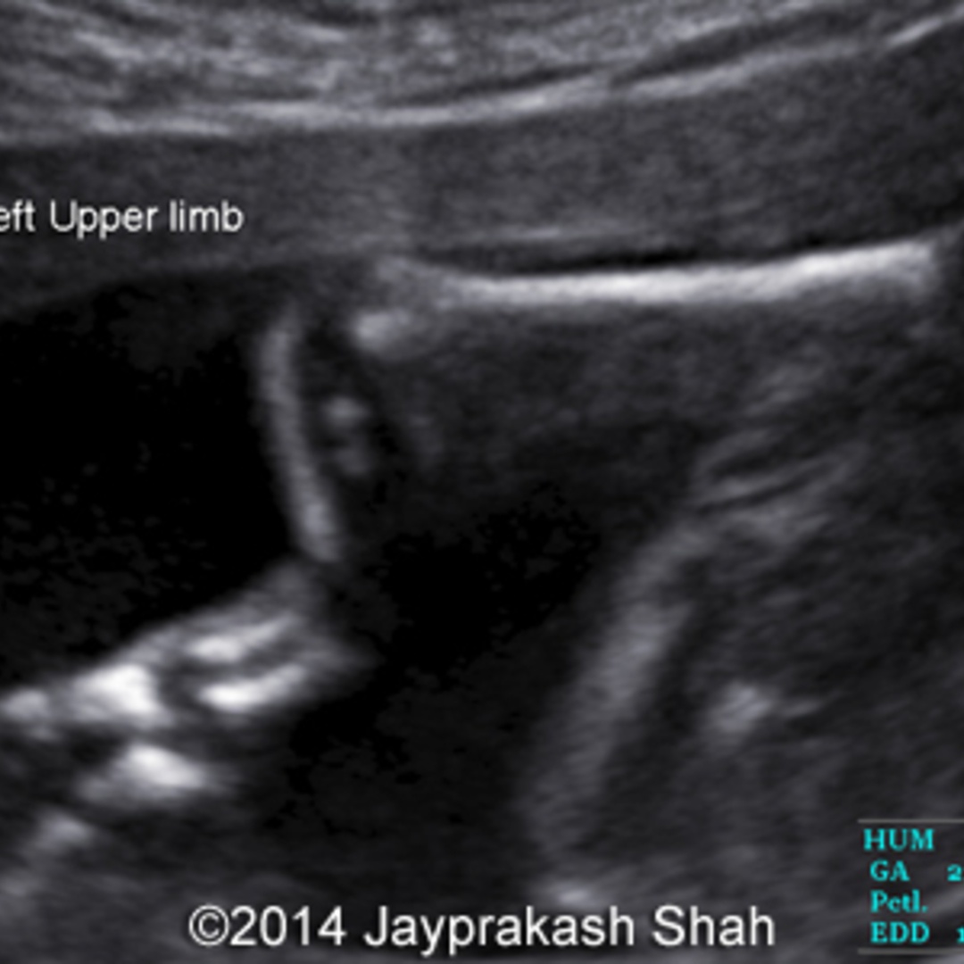 📃 Split hand syndrome