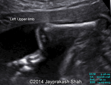 📃 Split hand syndrome