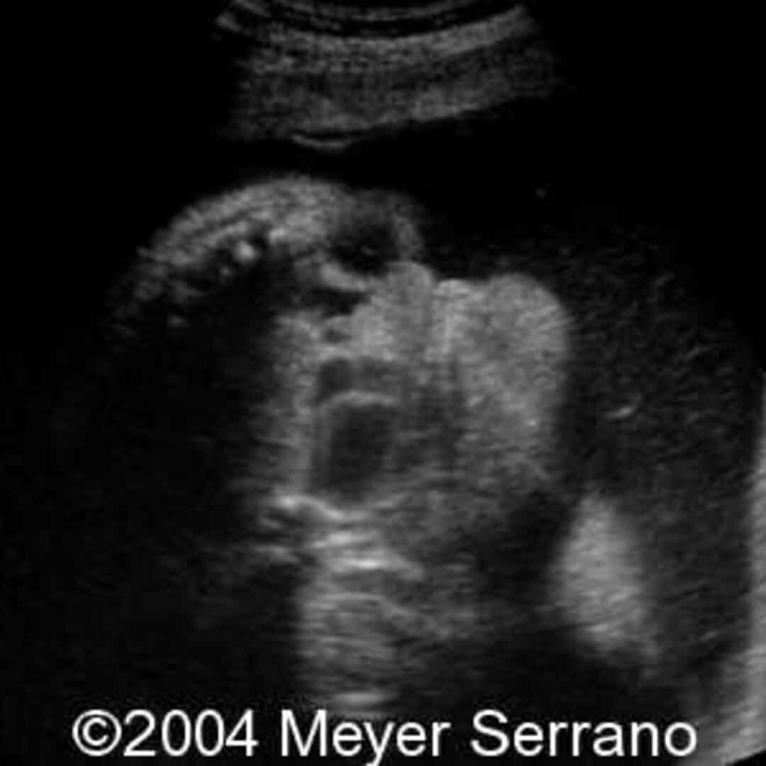 📃 Limb-body-wall complex