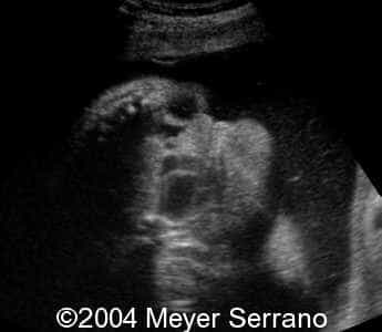 📃 Limb-body-wall complex