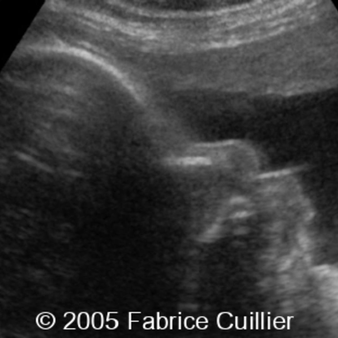 📃 46XX/47XY + 22 mosaicism