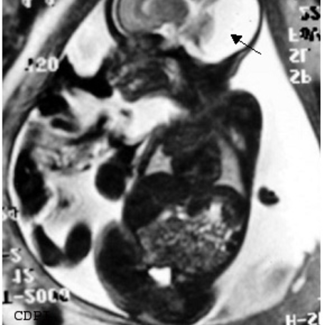π Dandy Walker Syndrome