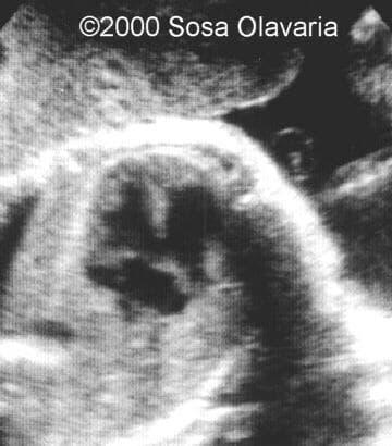 📃 Joubert syndrome