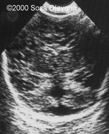 📃 Joubert syndrome