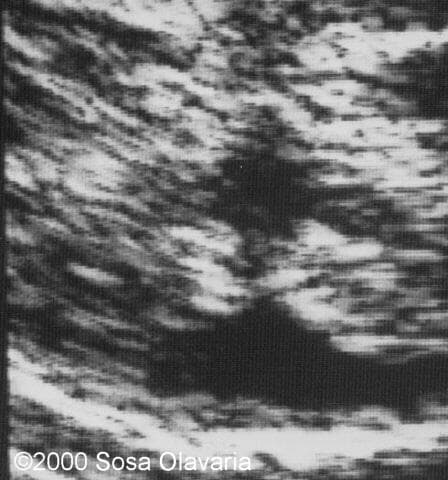 📃 Joubert syndrome