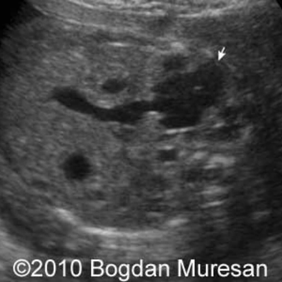 📃 Hepatic mesenchymal hamartoma