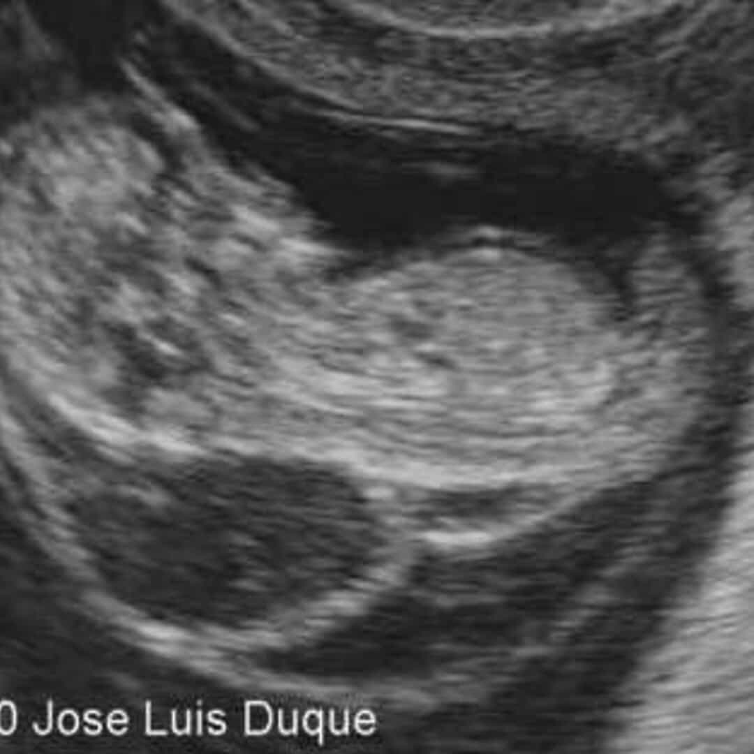 📃 Cystic hygroma and allantoic cyst in a 1st trimester fetus