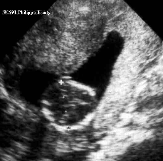 📃 Hydranencephaly