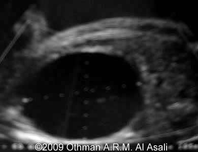 📃 Persistent urogenital sinus with hydrometrocolpos