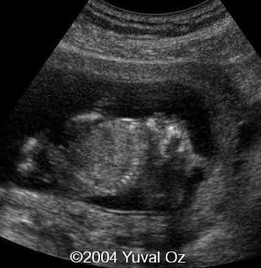 📃 Iniencephaly, 12 weeks