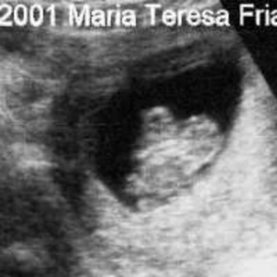 📃 Twins, conjoined, duplicata incompleta dicephalus