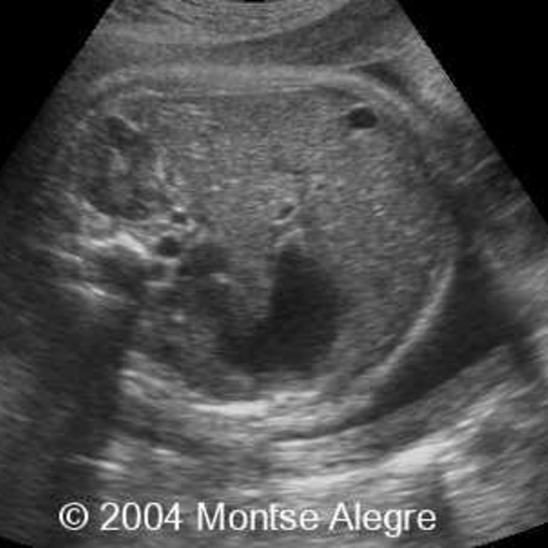 📃 Situs invertus, abdominal